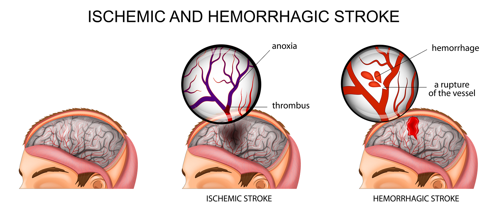New Ways To Act F A S T Initiatives To Speed Up Diagnosis Of Stroke 